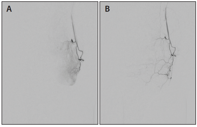 Genicular Artery Embolization to Treat Osteoarthritic Knee Pain ...