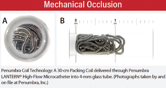 Ruby®, POD®, and Packing Coil: Immediate and Long-Term Mechanical ...