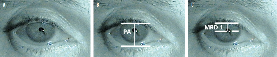 Ocular Ptosis and Its Differential Diagnosis - Modern Optometry