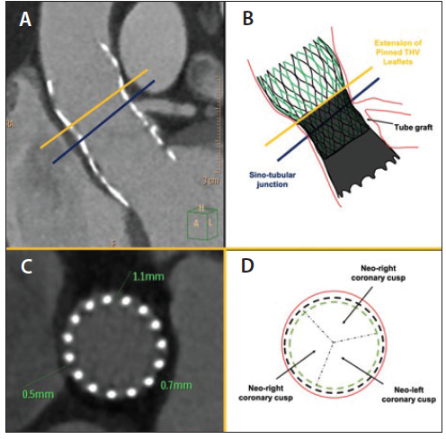 TAVR Pitfalls: Addressing Coronary Obstruction Risk - Cardiac ...
