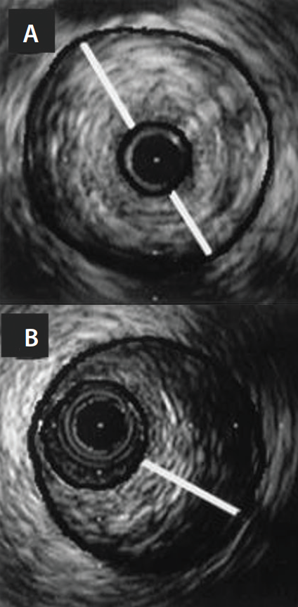 The Four Pillars of IVUS for the Endovascular Treatment of CLI ...