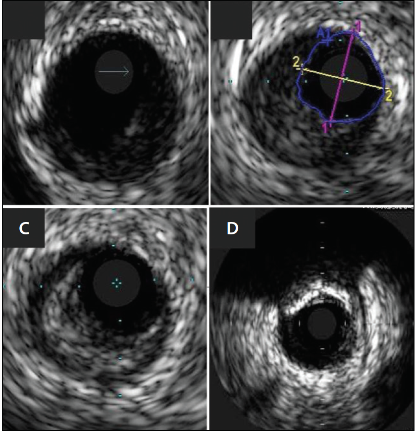 The Four Pillars of IVUS for the Endovascular Treatment of CLI ...