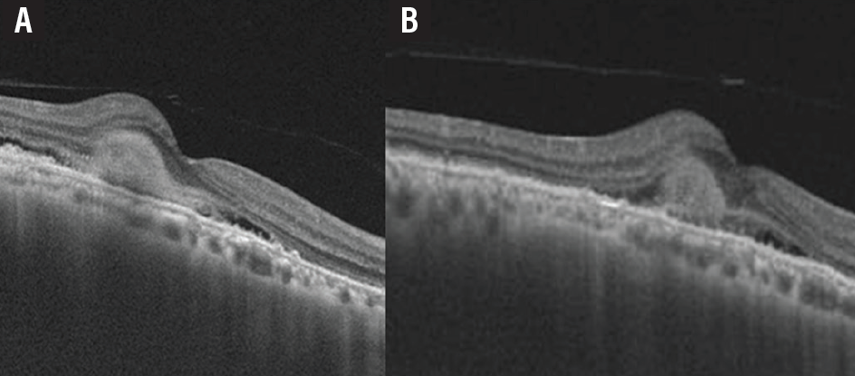 How Would You Handle These Tough AMD Cases? - Retina Today