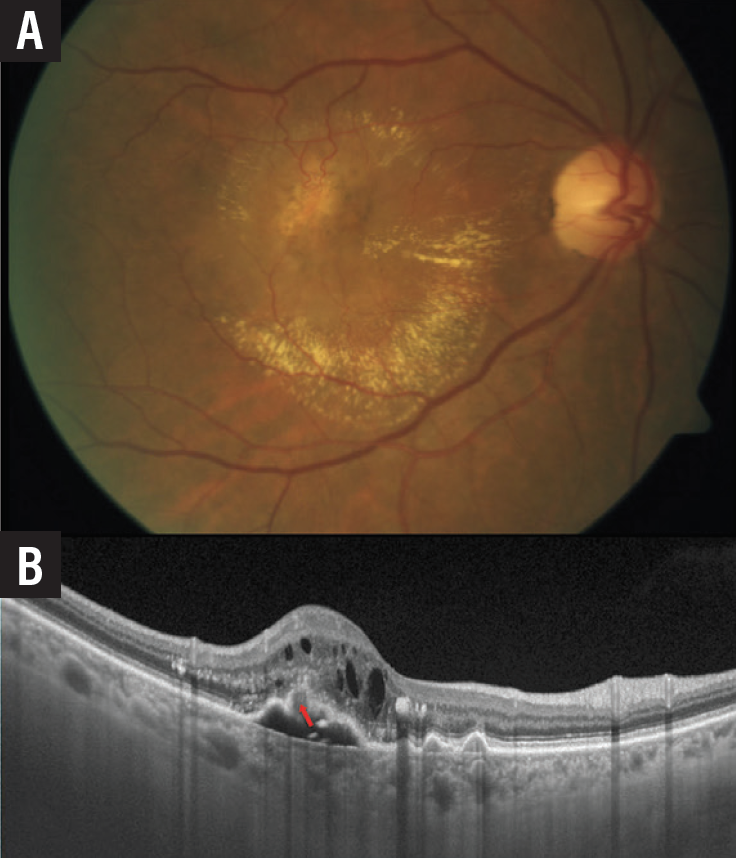 How Would You Handle These Tough AMD Cases? - Retina Today