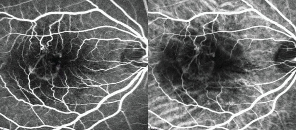 How Would You Handle These Tough AMD Cases? - Retina Today