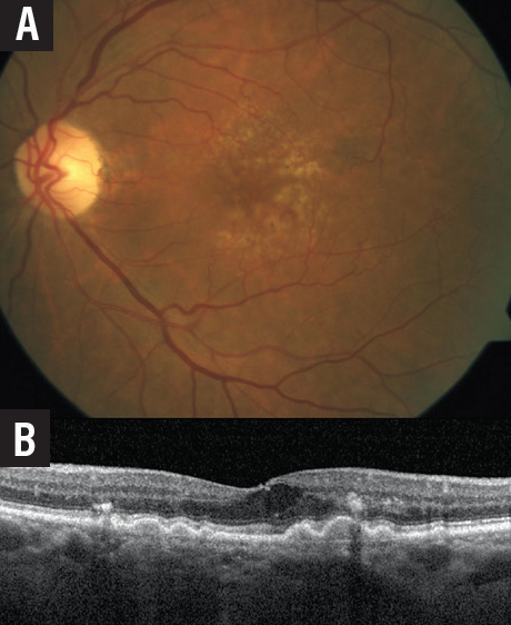 How Would You Handle These Tough AMD Cases? - Retina Today