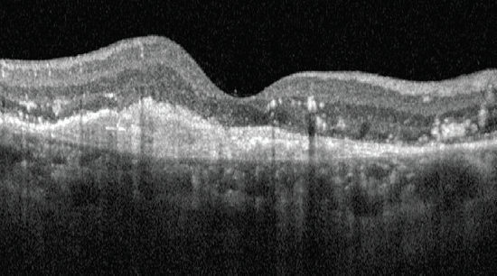 How Would You Handle These Tough AMD Cases? - Retina Today