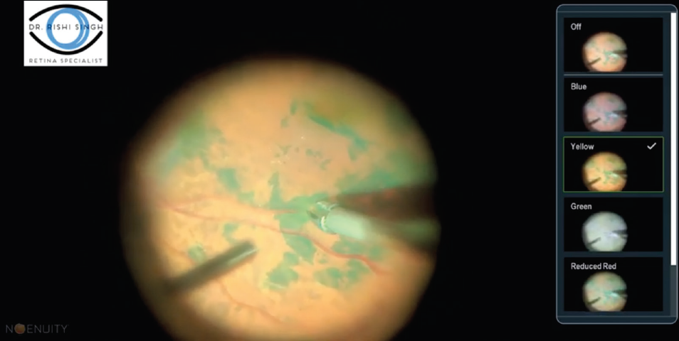 Improving Membrane Visualization in the OR - Retina Today