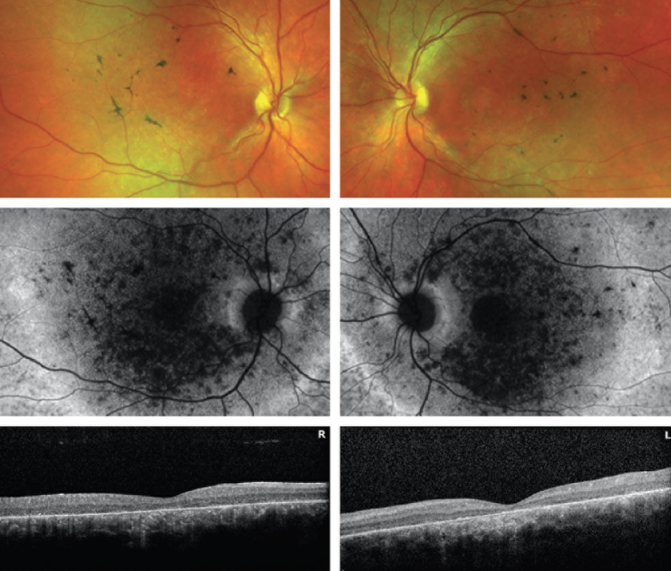 Tips and Tricks for Evaluating Children for Inherited Retinal ...