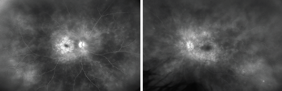 Localized Steroid Therapy for Chronic Noninfectious Posterior Uveitis ...