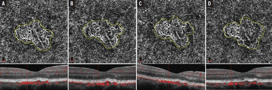 Clinical Utility of OCT Angiography for AMD - Retina Today