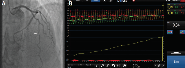 Pullback Pressure Gradient: Discriminating Focal and Diffuse Coronary ...