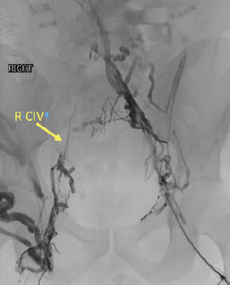 Iliac Vein Stenting: Best Practices for Patient Safety and Successful ...