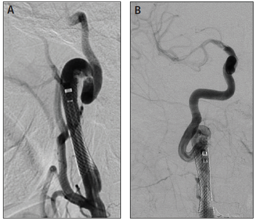 Tandem Occlusion With ICA Dissection - Endovascular Today