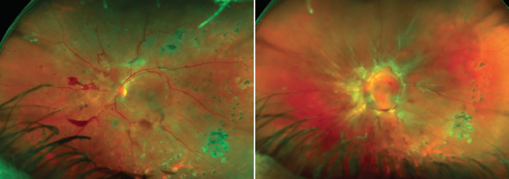 The Benefits of Early Surgical Intervention For Diabetic Retinopathy ...