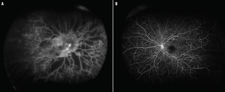 The Role of Peripheral Imaging in Diabetic Retinopathy - Retina Today