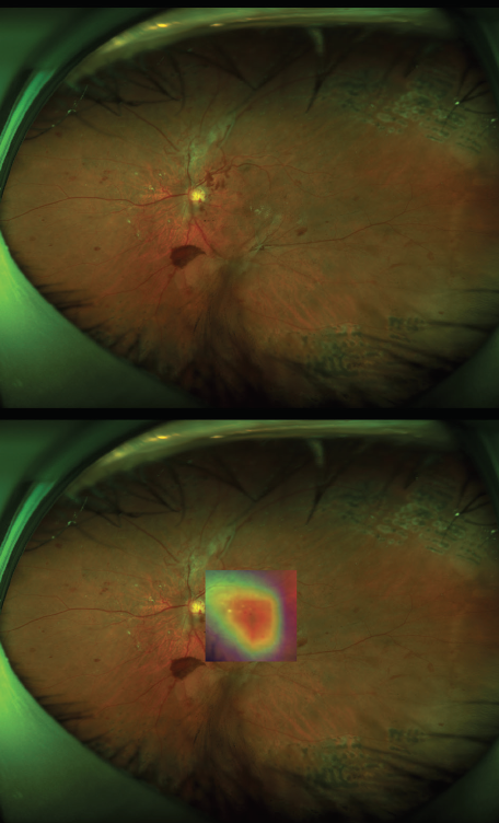 Detection of Diabetic Retinopathy Using Deep Learning Analysis - Retina ...
