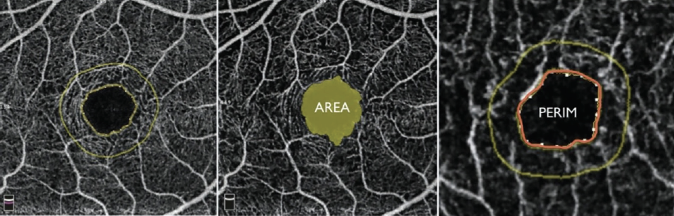 Measurement and Evaluation of the FAZ in a Healthy Latino Population ...