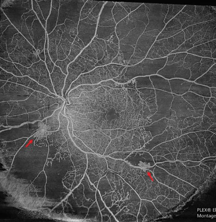 Clinical Utility of OCT Angiography for Retinal and Choroidal Vascular ...