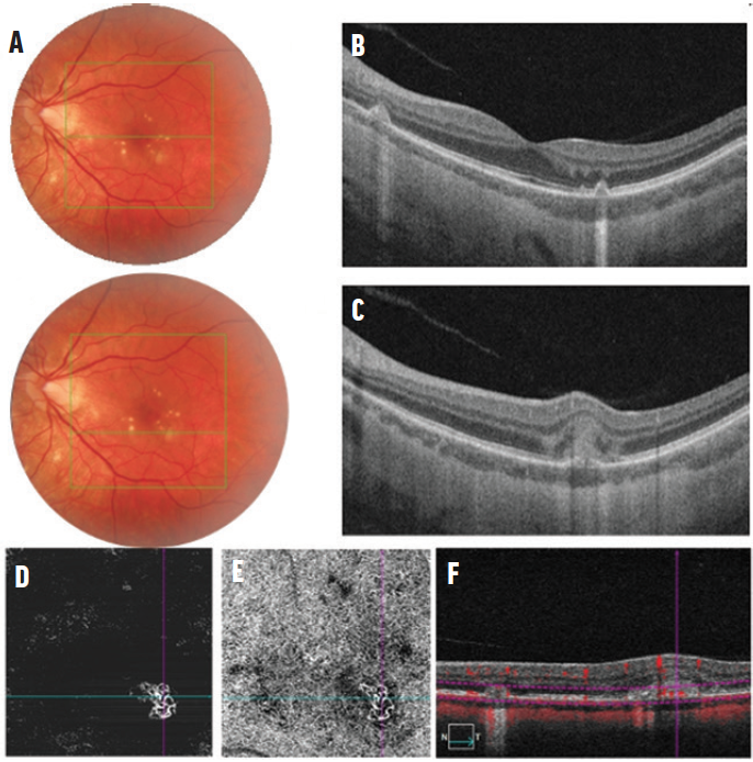 Clinical Utility of OCT Angiography for Retinal and Choroidal Vascular Diseases - Retina Today