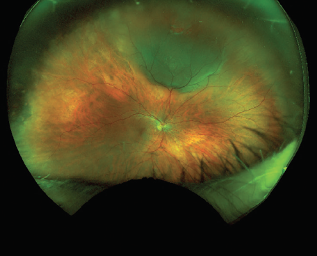 How to Handle Eye Drop Allergies During Surgery - Retina Today