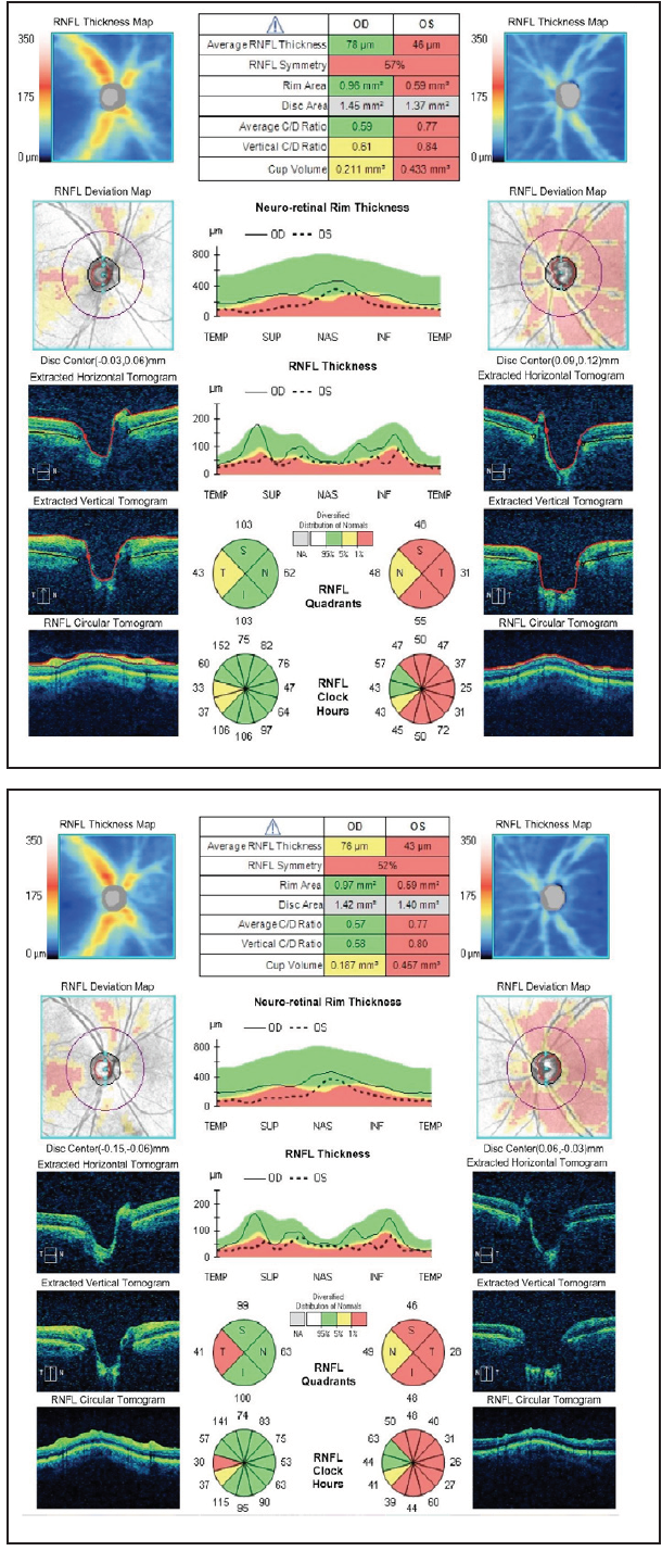 Pigment Dispersion Glaucoma - Glaucoma Today