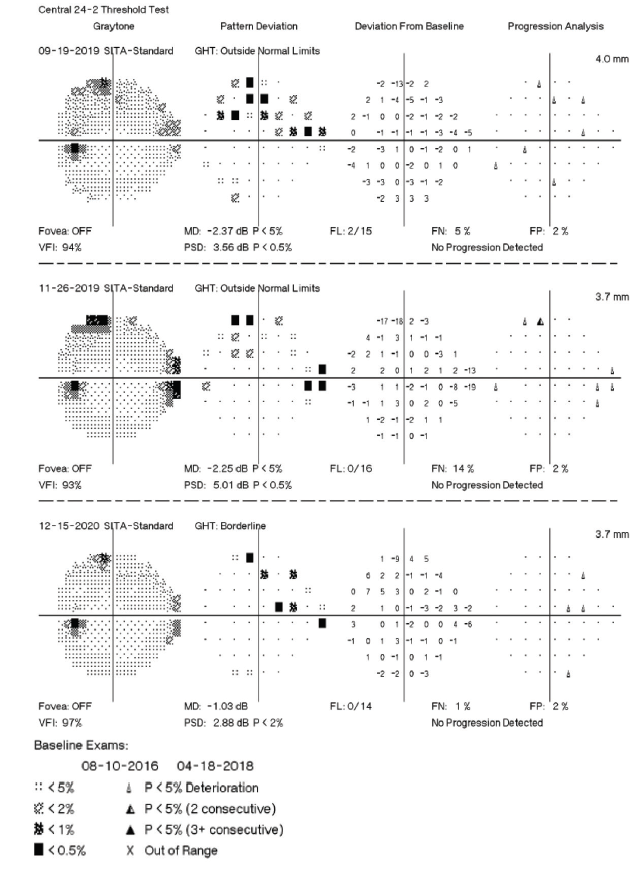An Update on Standard Automated Perimetry - Glaucoma Today