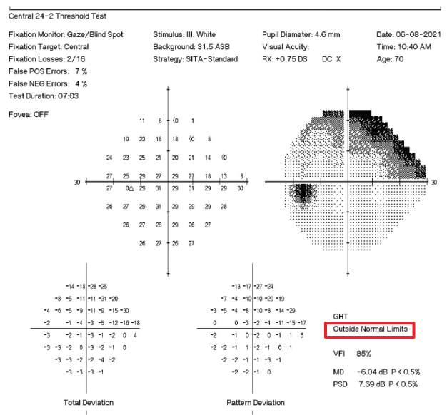 An Update on Standard Automated Perimetry - Glaucoma Today