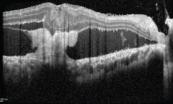 How To Handle Traumatic Retinal Detachments - Retina Today