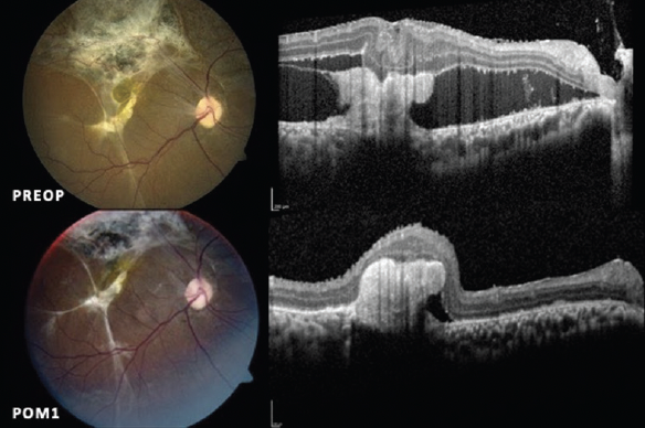 How To Handle Traumatic Retinal Detachments - Retina Today