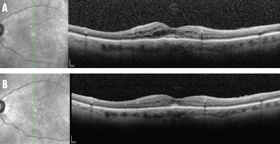 Management of Chronic Postoperative CME With Uveitis - Retina Today