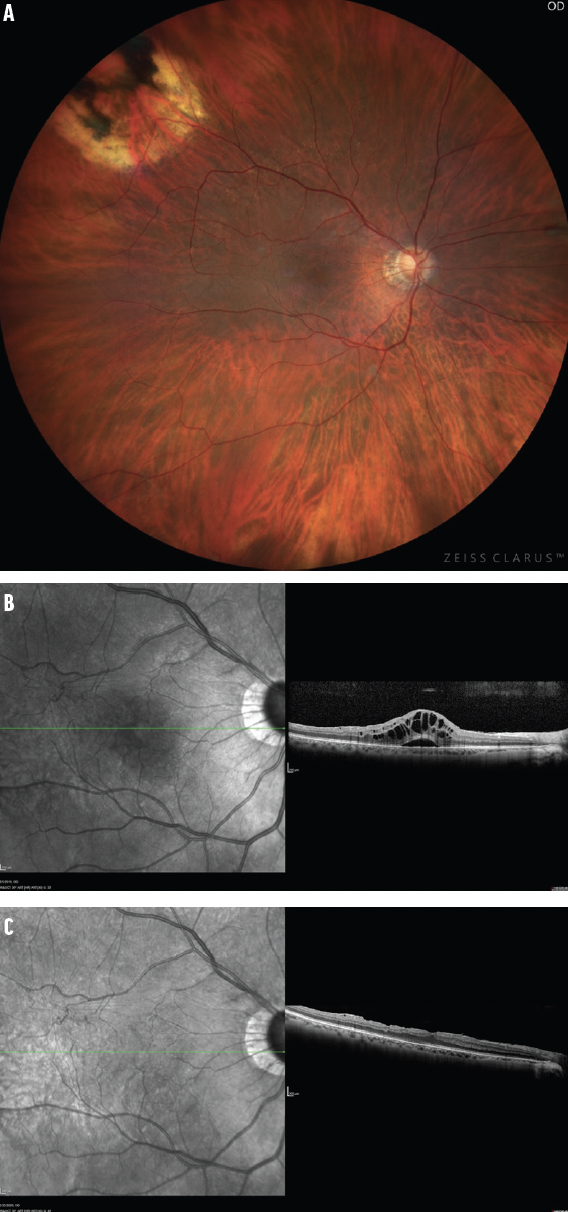 Management of Chronic Postoperative CME With Uveitis - Retina Today