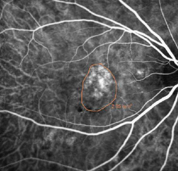 Diagnosing PCV With OCT B-Scan - Retina Today