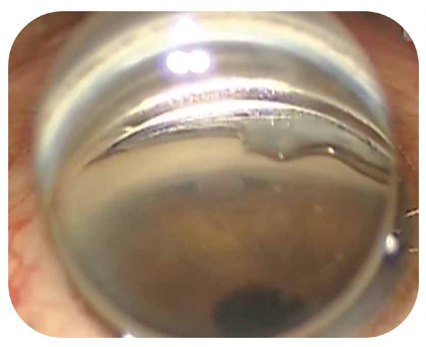 Miniject: Harnessing the Drainage Power of the Supraciliary Space ...