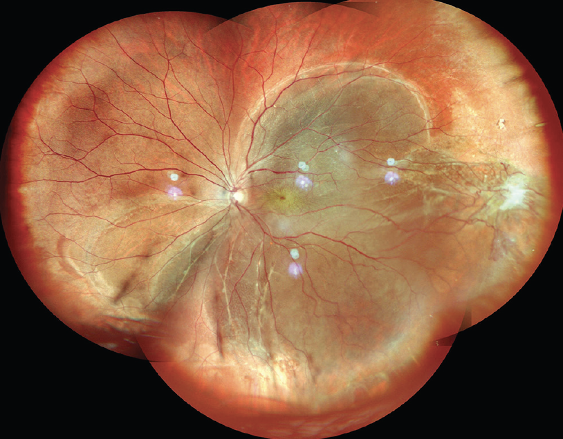 SLO-Based Widefield Imaging: An Atlas of Retinal Detachments - Retina Today