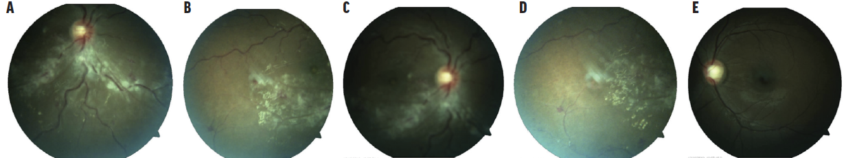 An Unusual Case of Unilateral Purtschers Retinopathy - Retina Today