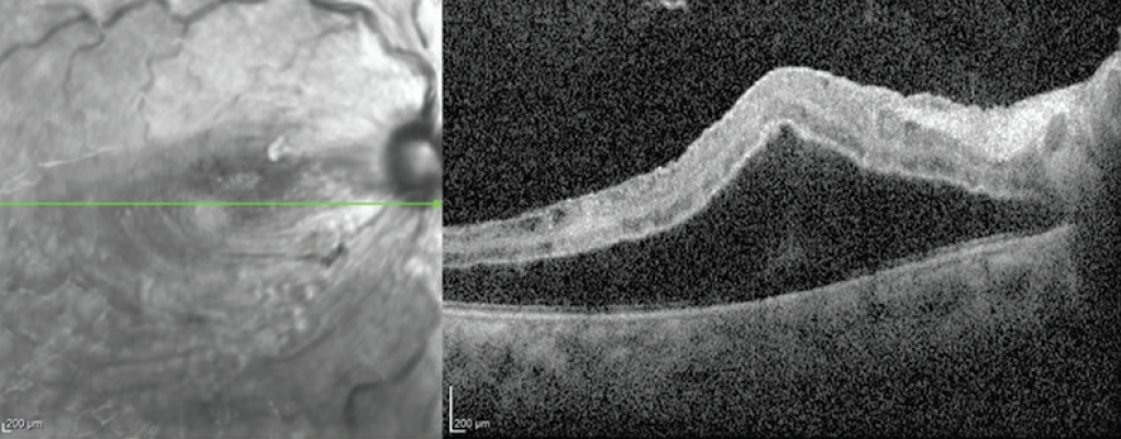 An Unusual Case of Unilateral Purtschers Retinopathy - Retina Today