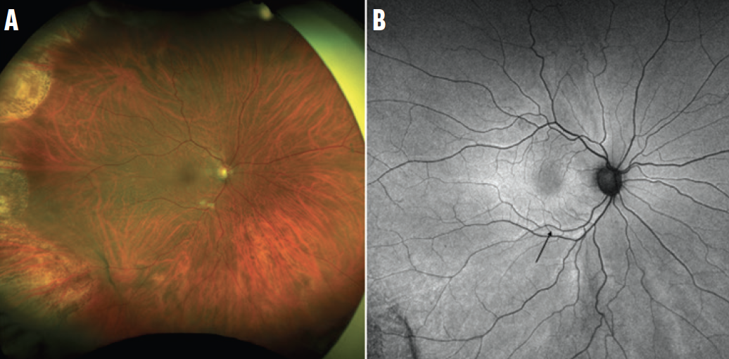 RRD Repair Integrity: Vitrectomy Versus Pneumatic Retinopexy - Retina Today