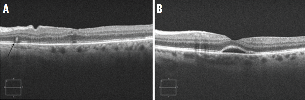 RRD Repair Integrity: Vitrectomy Versus Pneumatic Retinopexy - Retina Today