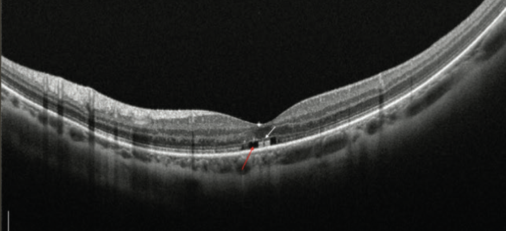 RRD Repair Integrity: Vitrectomy Versus Pneumatic Retinopexy - Retina Today