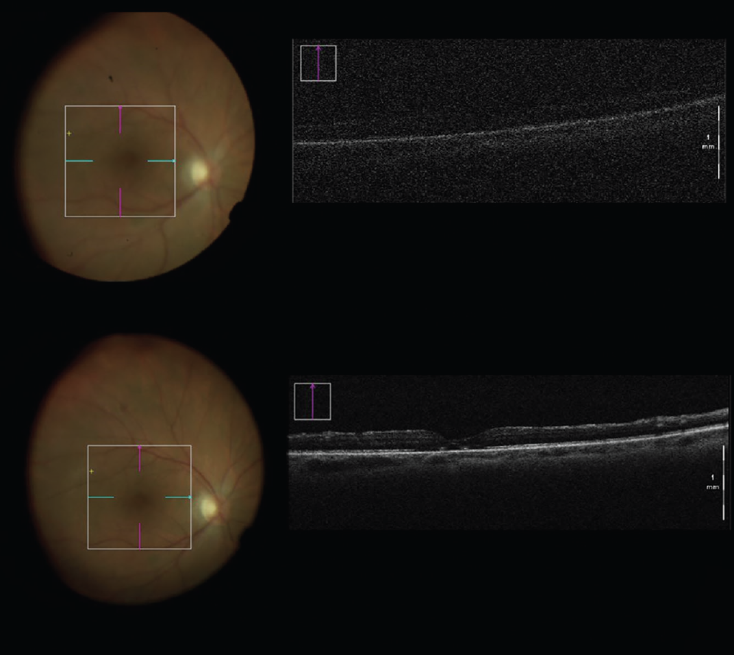 Maximizing iOCT Quality in the Surgical Suite - Retina Today