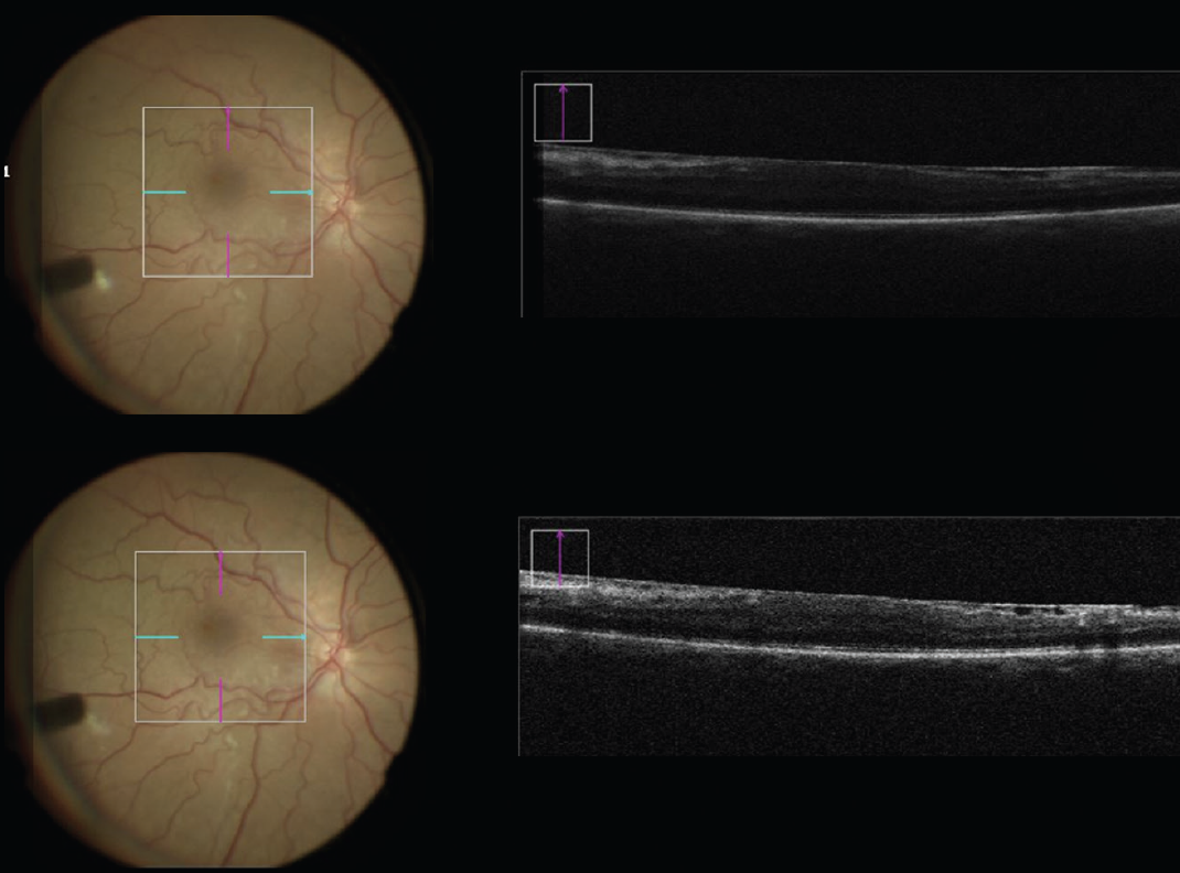 Maximizing iOCT Quality in the Surgical Suite - Retina Today