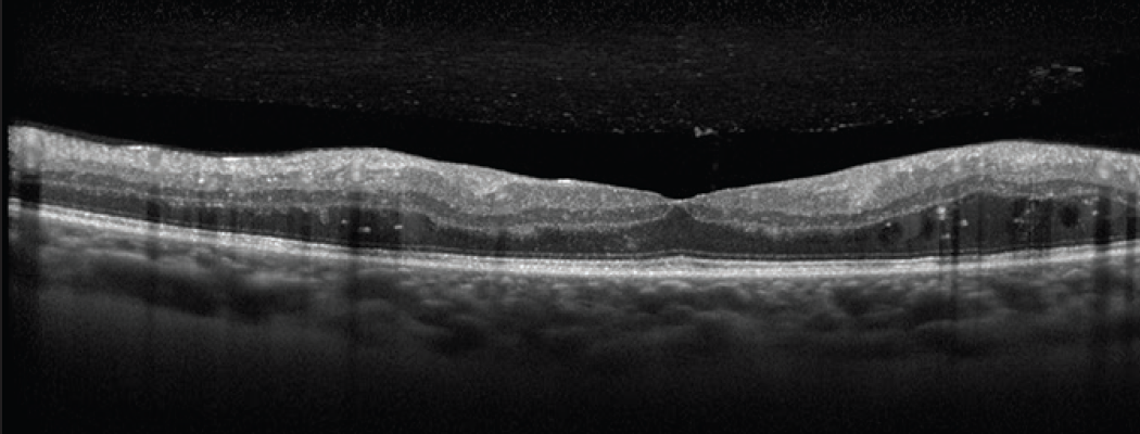 An Overview of Biomarkers in Retinal Disease - Retina Today