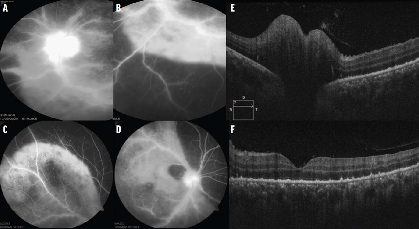 Dramatic Ocular Manifestations of an STD - Retina Today