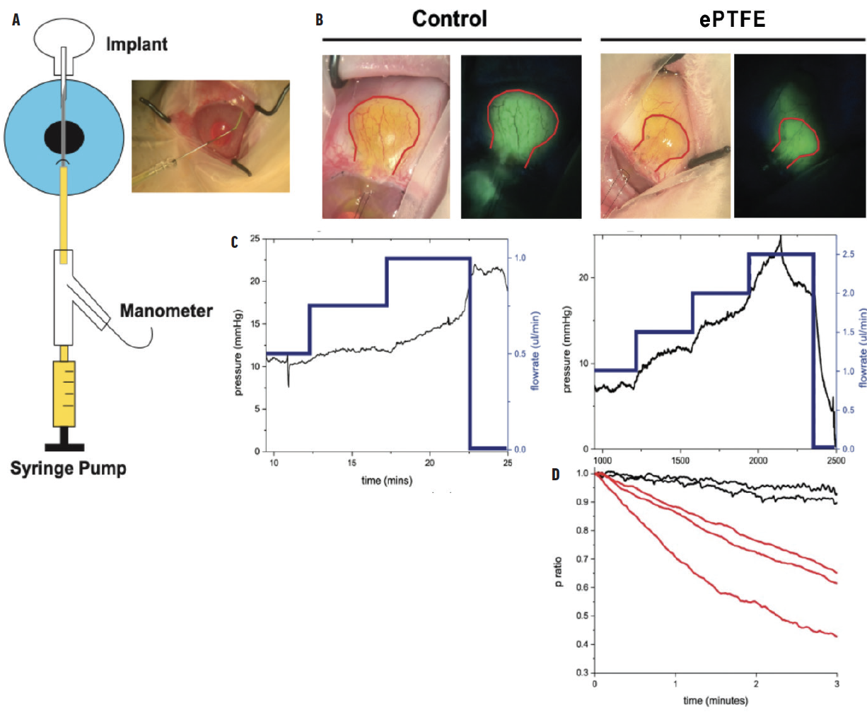 Overcoming Bleb Encapsulation With Biomaterials - Glaucoma Today