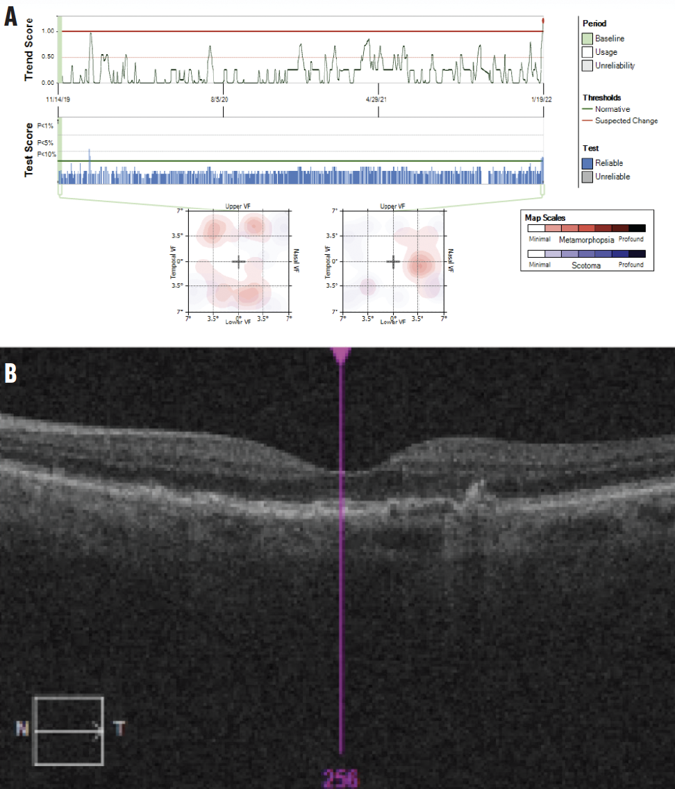 At-Home Monitoring in Your Office - Retina Today