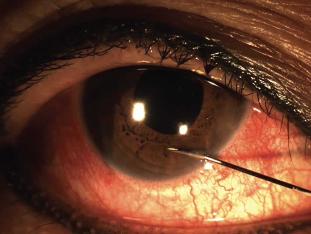 Leaky Anterior Chamber Paracentesis - Glaucoma Today
