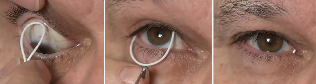 Targets of the Medication Pipeline - Glaucoma Today