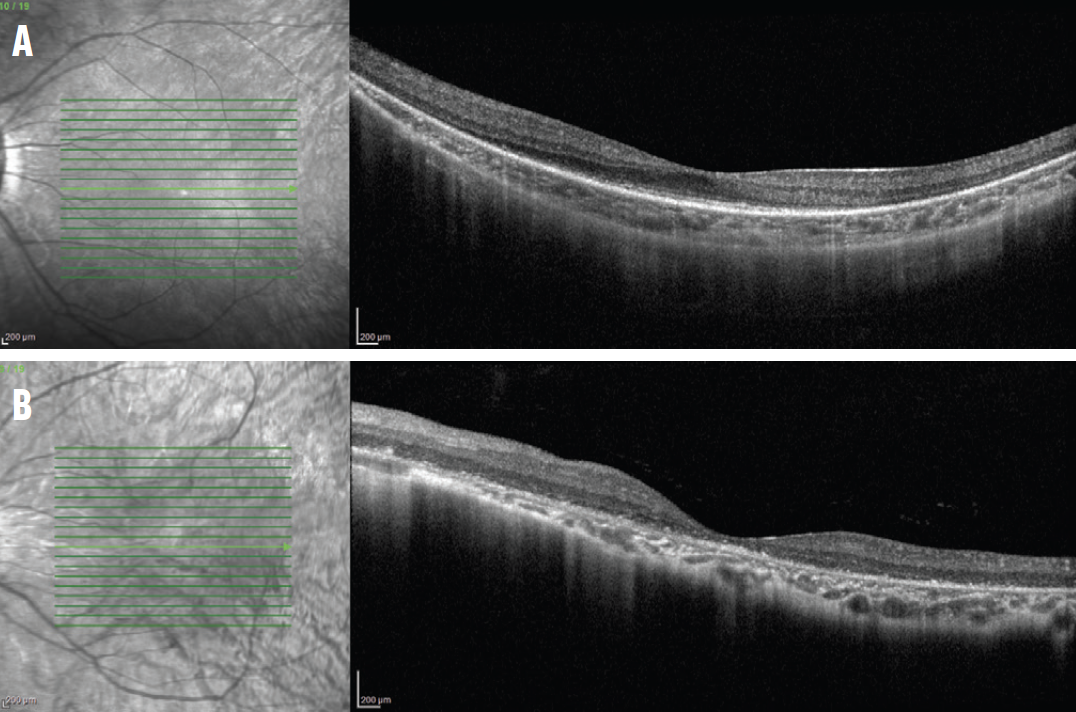 The Ups and Downs of Gene Therapy Research - Retina Today