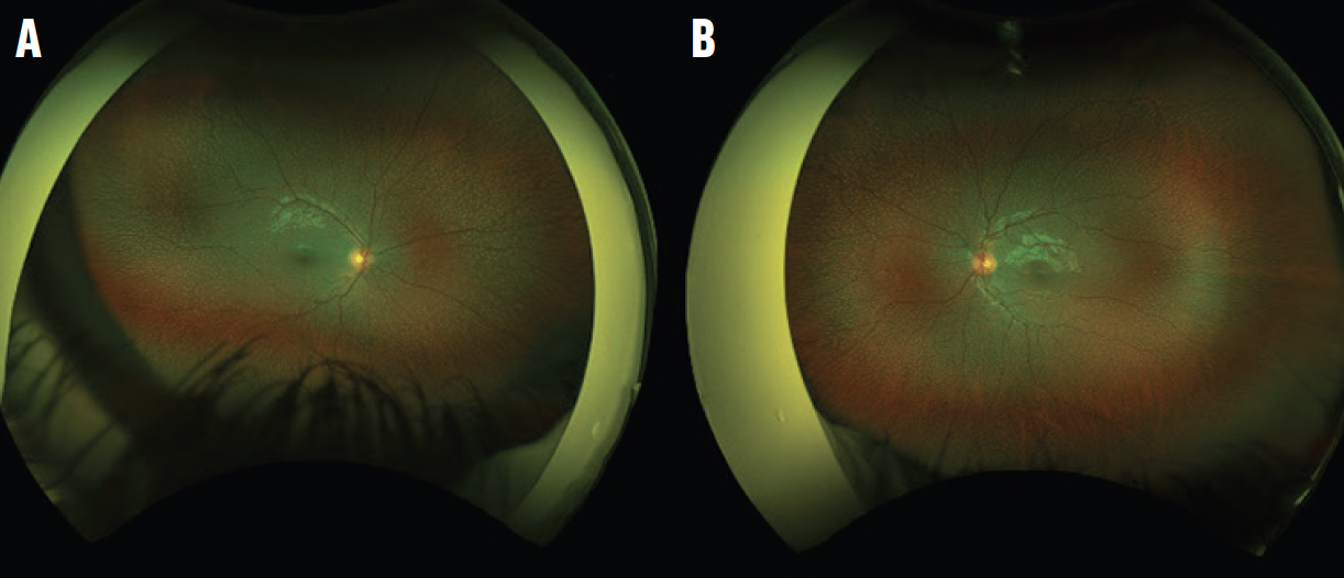 Mystery Cases: Rare and In Your Chair - Retina Today